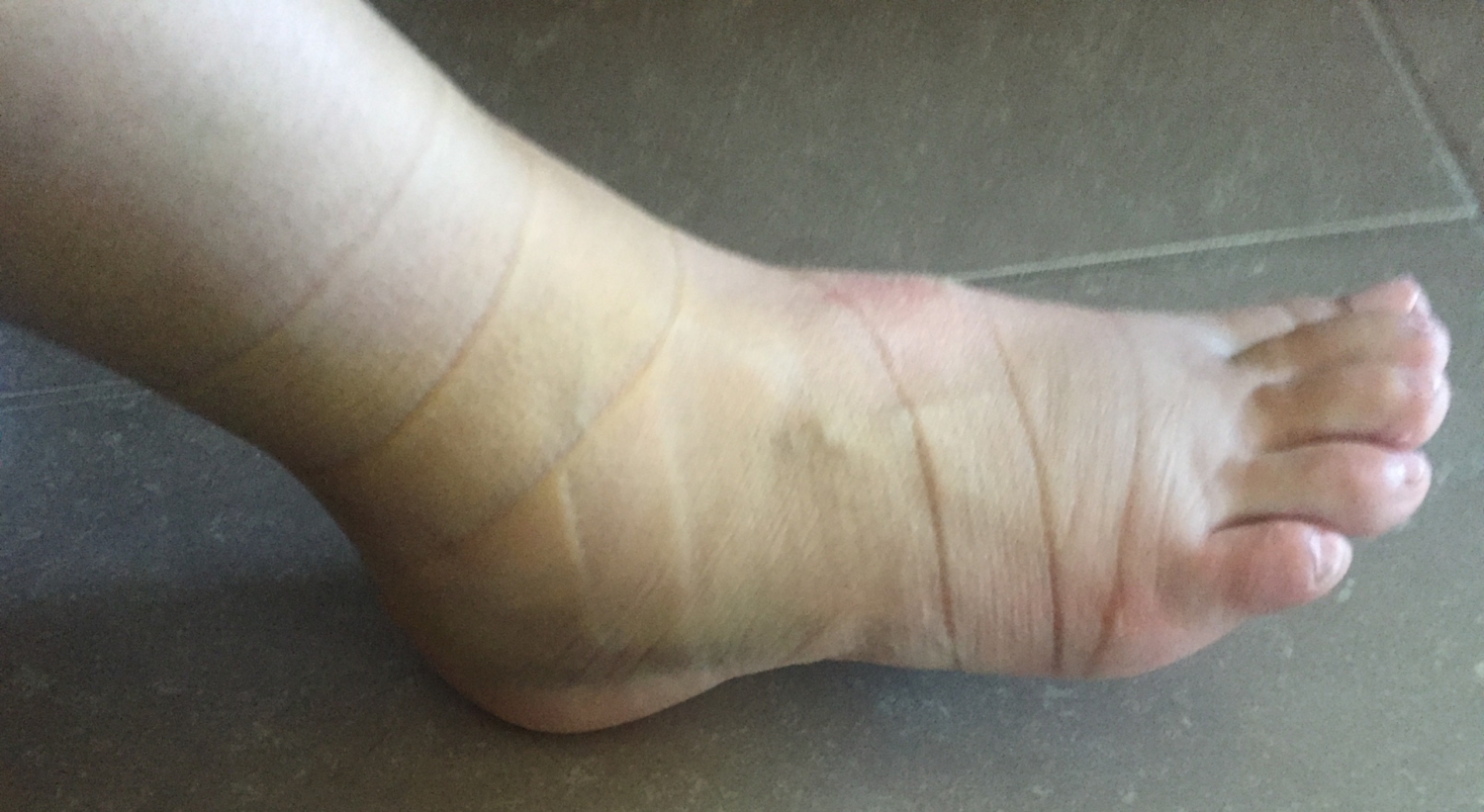 Top 10 myths about ankle sprains - Shepp Physio & Podiatry